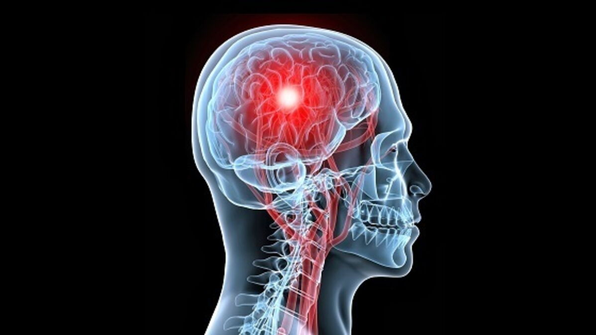 Stroke: Definition, Signs, Symptoms, Causes, Risks, Treatment ...