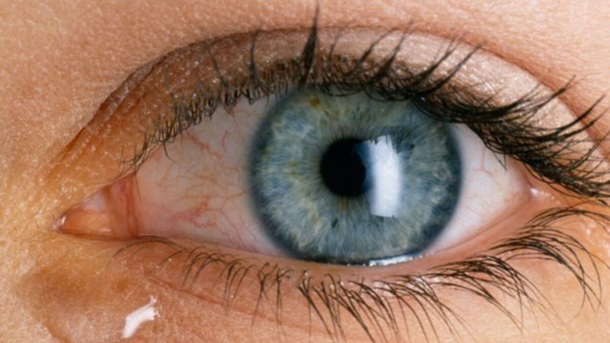 Conjunctivitis (Pink Eye): Signs, Symptoms, How To Treat It