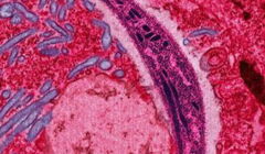 Tracheitis (Viral And Bacterial): Symptoms, Treatment, Recovery Time