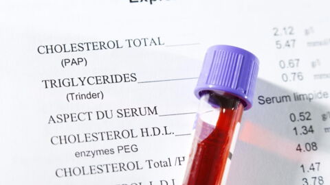 Cholesterol: Understanding Levels, Symptoms, Causes, And How To Treat It