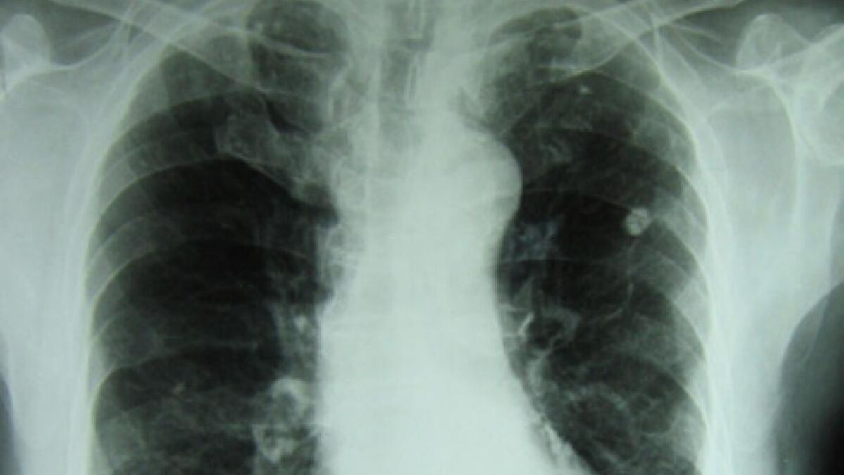 Tuberculosis (TB): Causes, Symptoms, And Treatments