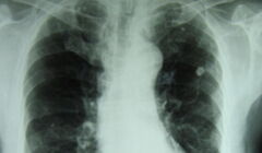 Degenerative Disc Disease (Discopathy): Symptoms, Causes, Treatment ...