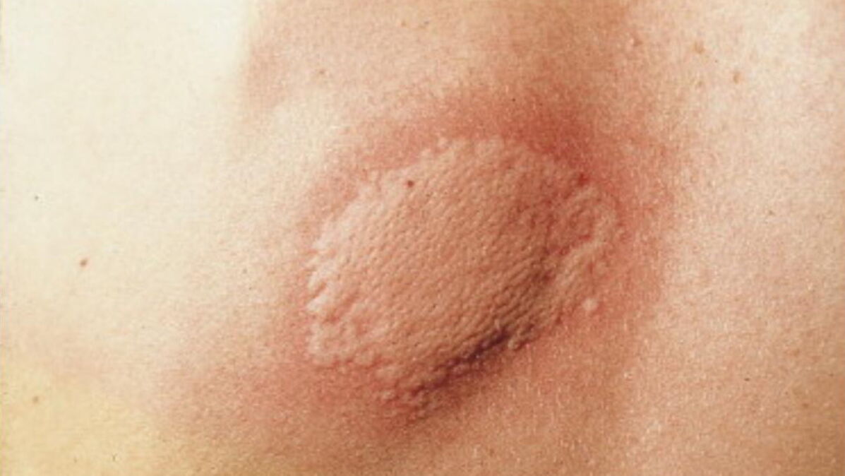 Hives (Skin Rash): Treatment, Causes, Symptoms
