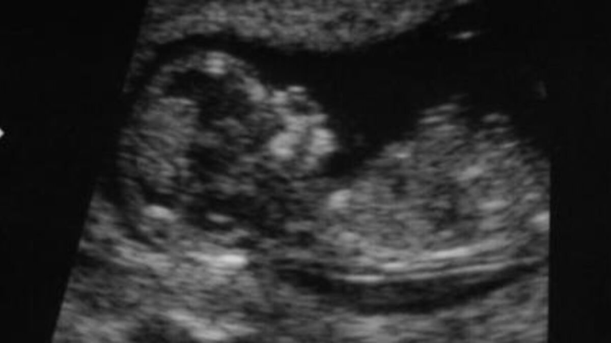 Whilst Already Pregnant, A Rare Phenomenon Allowed Her To Conceive A ...