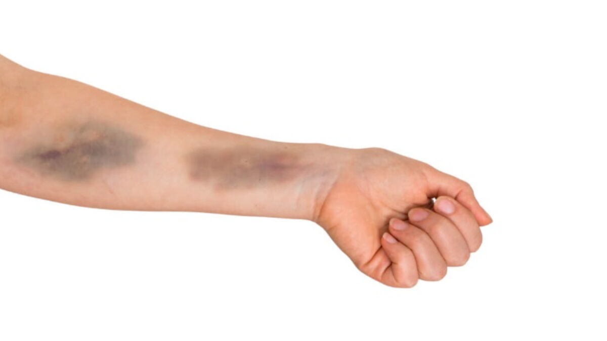 After A Night Out, She Woke Up Covered In Bruises And Couldn’t Explain ...