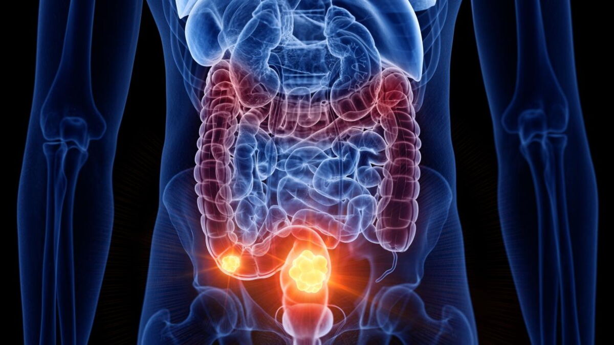 5 Little-Known Colon Cancer Symptoms To Look Out For