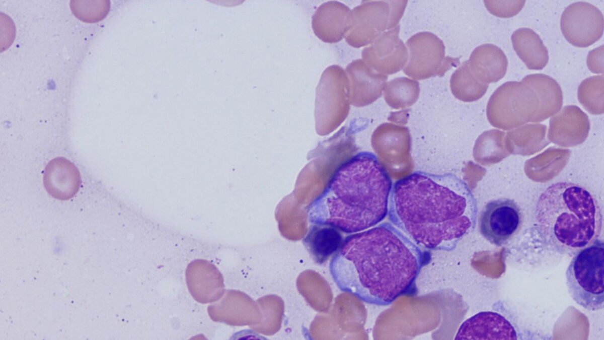 What is multiple Myeloma, a type of bone marrow cancer?