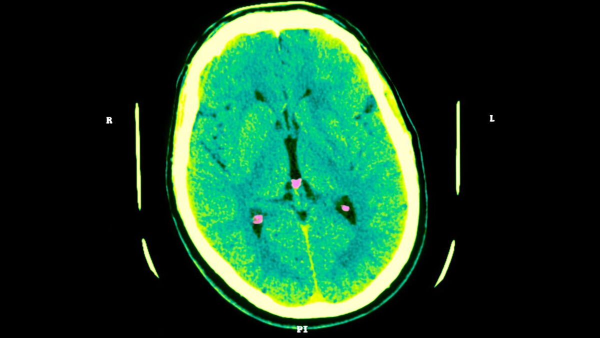 A strange brain disease is on the rise in Canada and has authorities ...