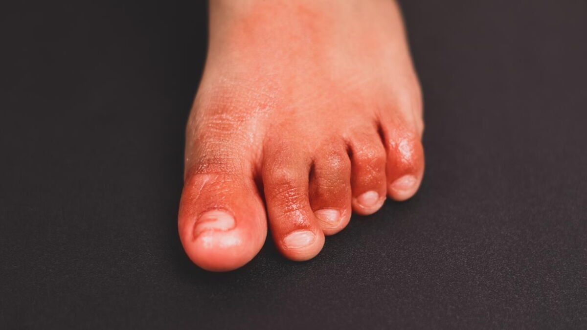 COVID toes: The disturbing new coronavirus symptom
