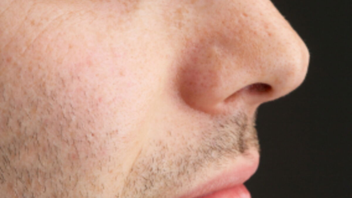 Il perd son nez à cause d'un cancer et s'en fait repousser un nouveau ...