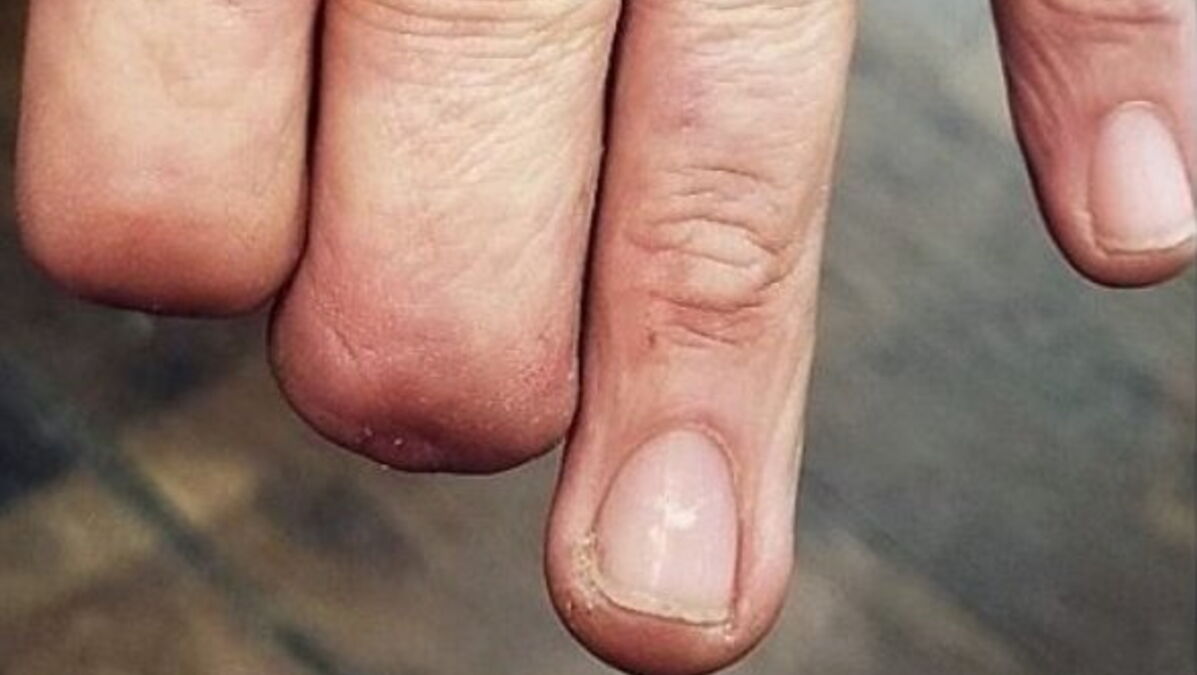 Un tatoueur, Eric Catalano, dessine des ongles sur des doigts amputés