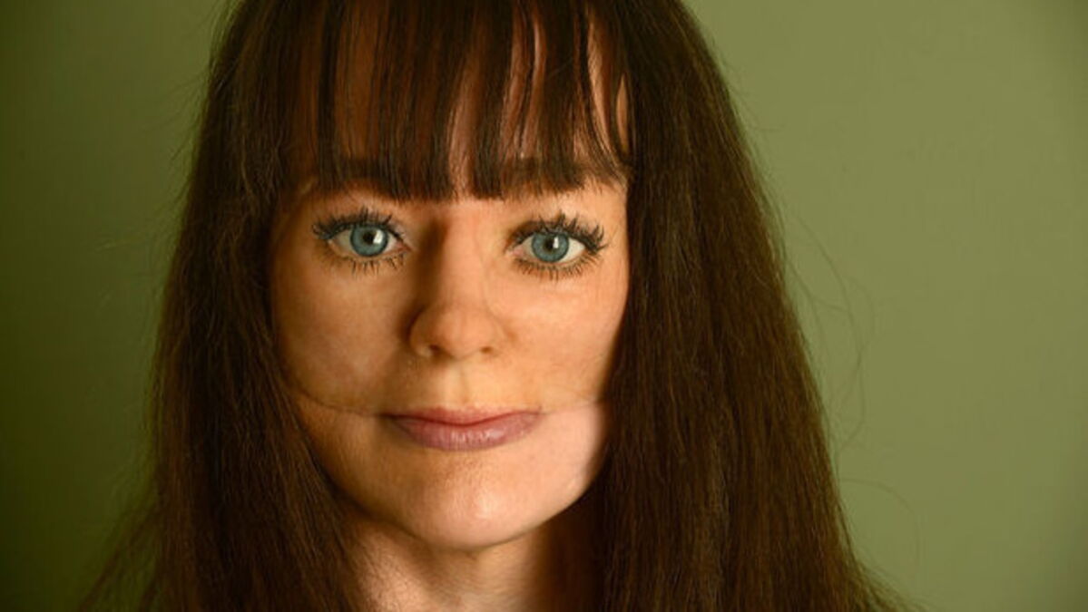 Après avoir reçu une balle en plein visage, Michelle Fox porte une ...