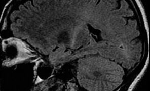 Degenerative Diskopathie: Definition, Symptome, Therapie und Behandlung ...