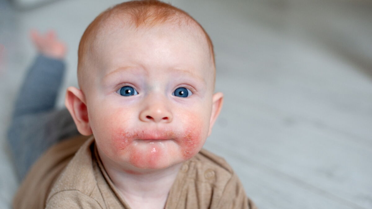 Atopische Dermatitis – Symptome, Ursachen, Therapie