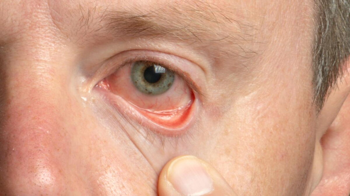 Glaucome : symptômes, causes, traitement, de quoi s'agit-il