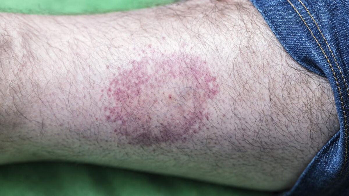 Maladie de Lyme : symptômes, traitement, photo, diagnostic, de quoi s ...