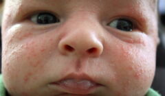 Spasmophilia: What Is It? Signs, Symptoms & Treatment