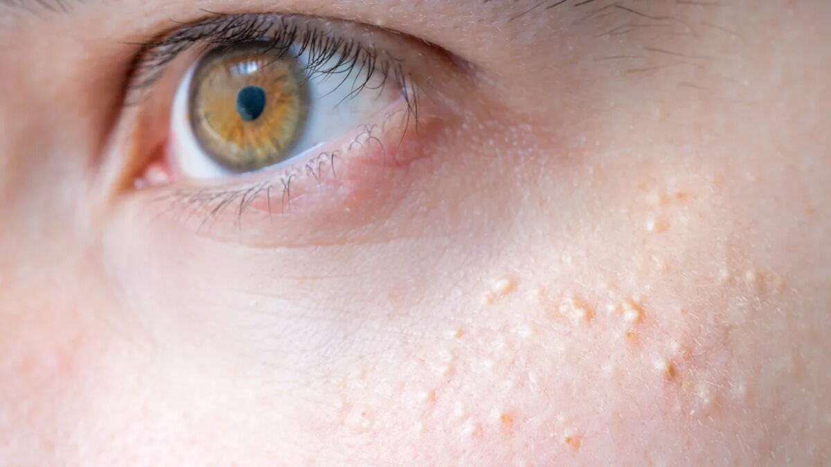 Milia: what causes these small white dots under your eyes?