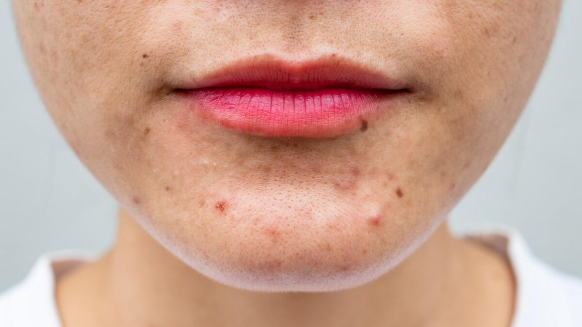 Cystic acne: What it is and how to treat it