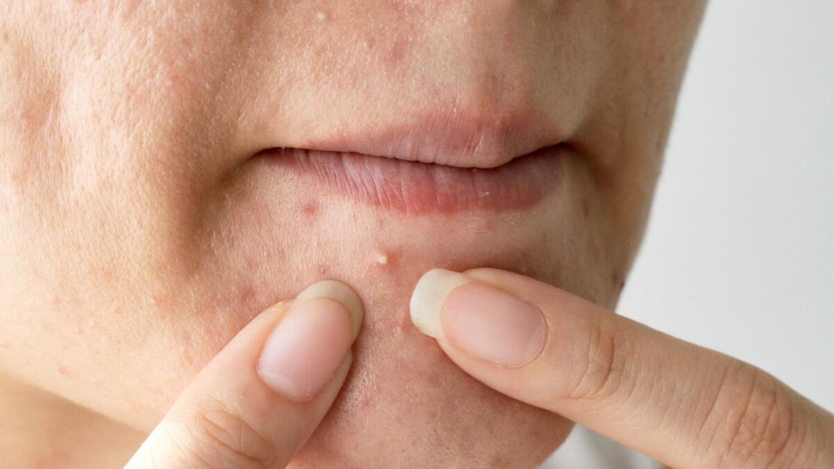 Understanding the six types of acne and how to treat them