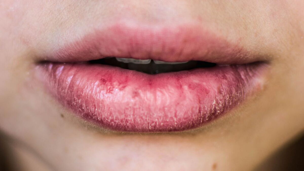 These Marks on Your Lips Could Be an Indication of a Serious Illness