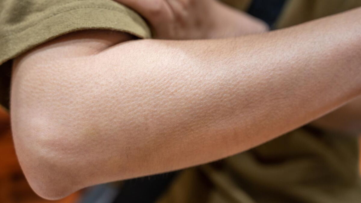 Goosebumps: This is the reason why you get them