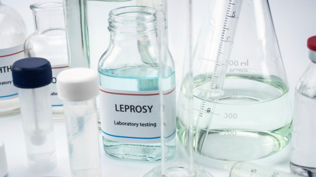 Leprosy cases on the rise: Here's what you should know about this ...