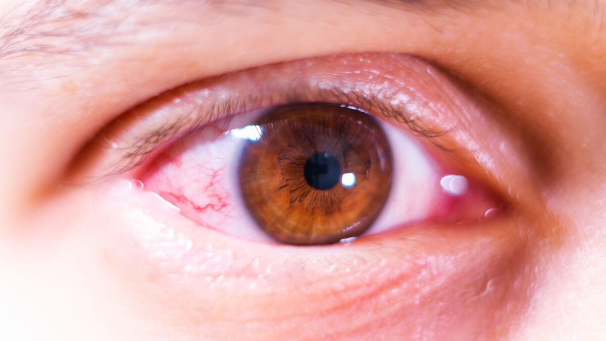 Eye infarction increases the risk of stroke: This is why quick action ...