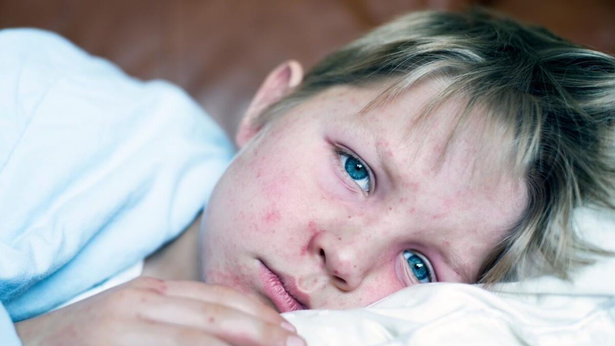 This potentially fatal Victorian-era disease could be making a comeback ...