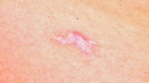 Hypertrophic scars explained: Why they occur and how to treat them