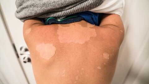 How to know if you’re allergic to the sun