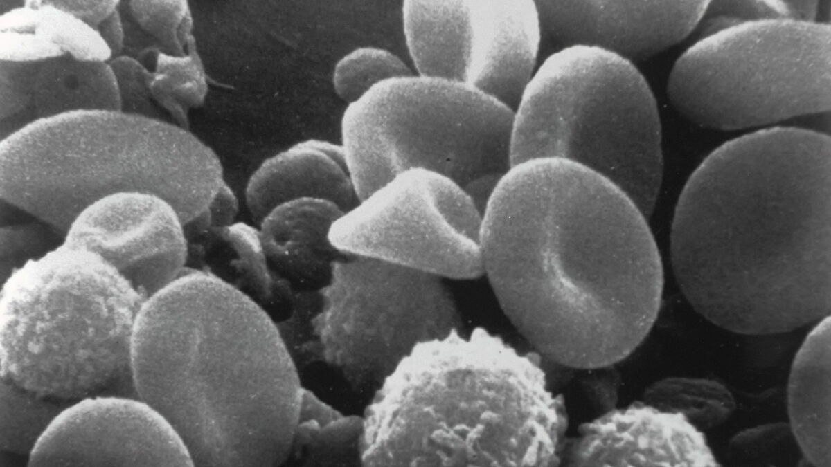 'Microscopic blood clots’ have been discovered in long COVID patients