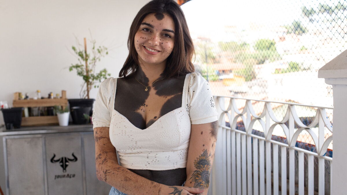 Woman covered in birthmarks learns to embrace her unique look