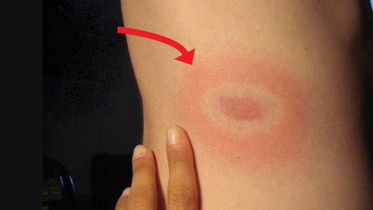 Les tiques attaquent, quels sont les bons gestes à avoir