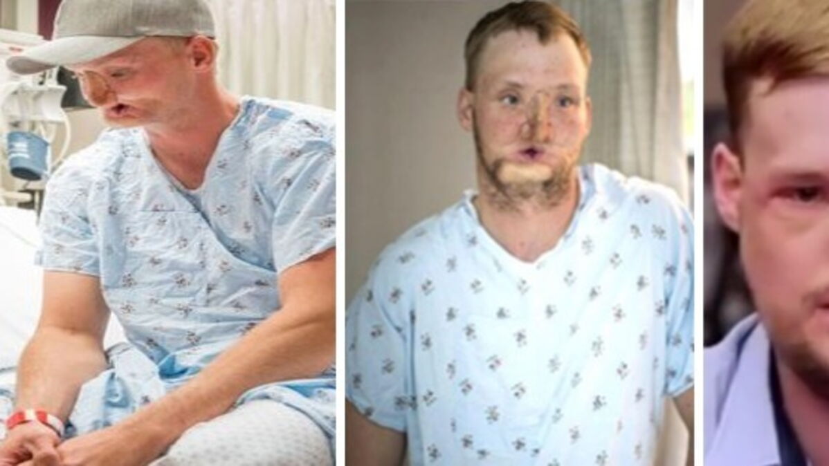 Les incroyables résultats d'une greffe complète du visage