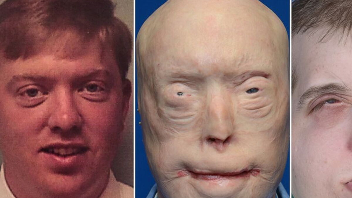 Patrick Hardison : un an après sa greffe au visage, sa vie a bien changé