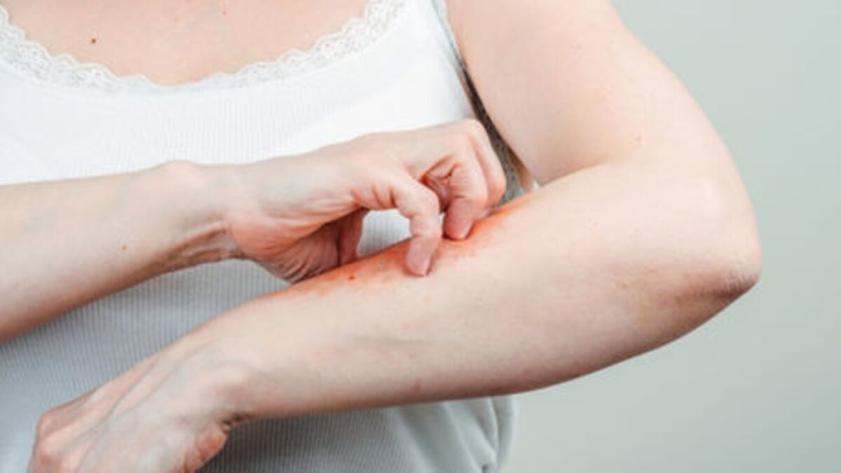 Psoriasis : causes, symptômes et traitement