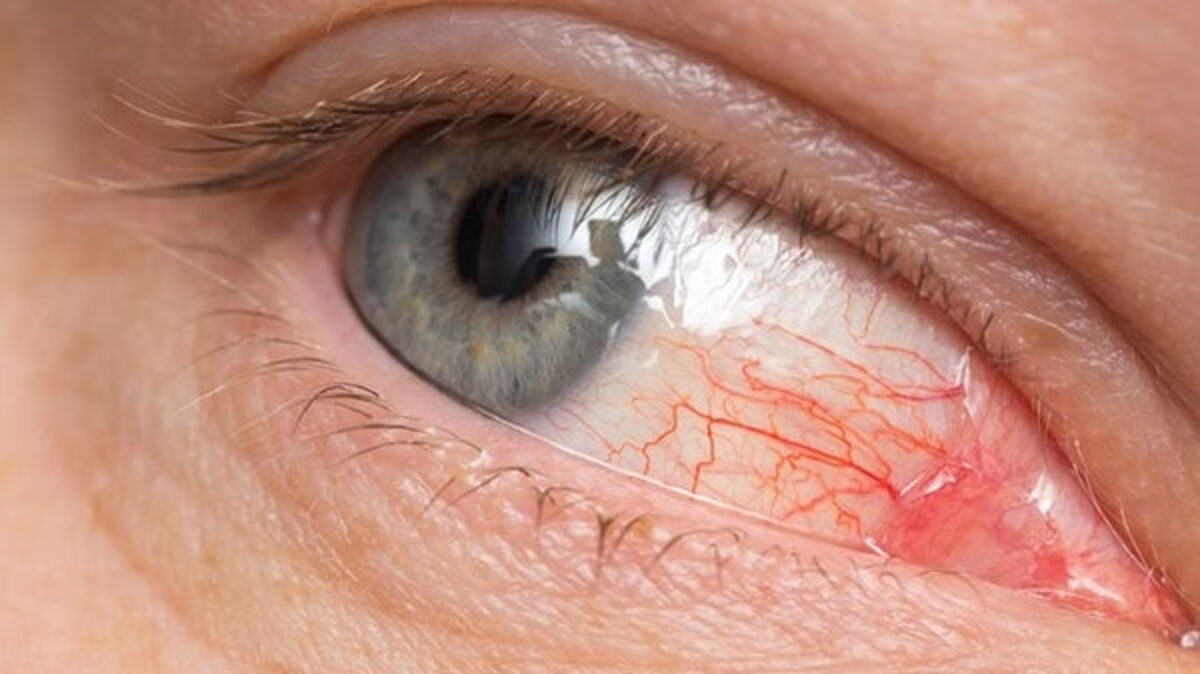 Conjonctivite : symptômes, causes, traitement, contagion