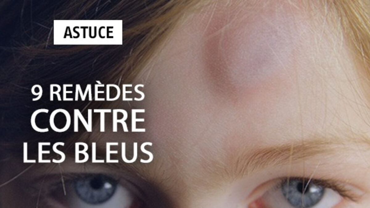 9 remèdes contre les bleus