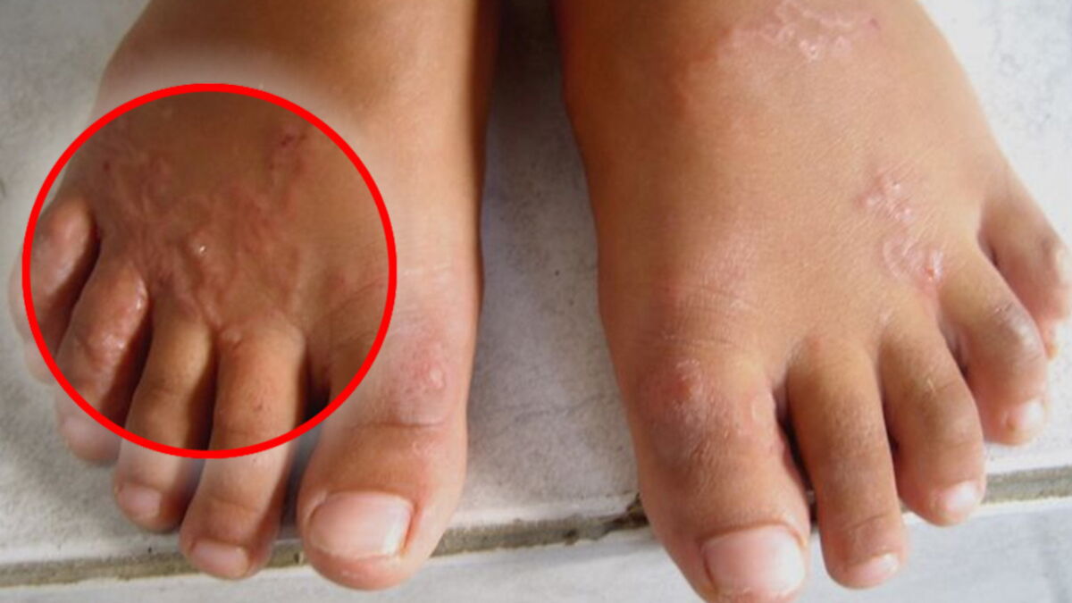 Myiase Cutanée Et Sous Cutanée : Symptômes, Traitements – TH Elek