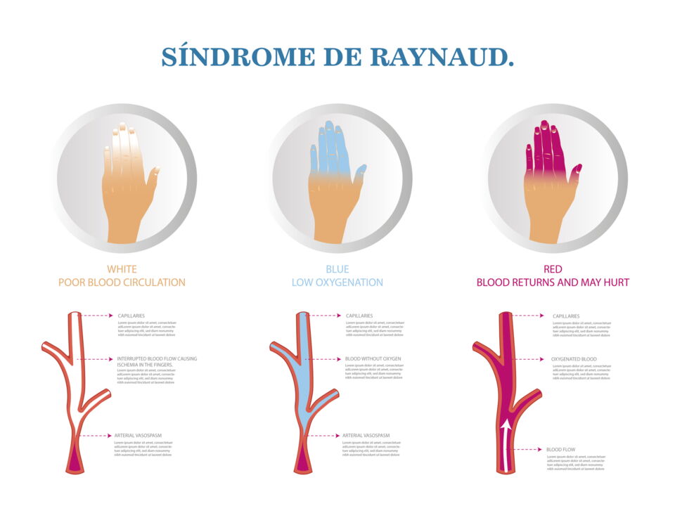 Syndrome de Raynaud : traitement, causes, diagnostic, de quoi s'agit-il
