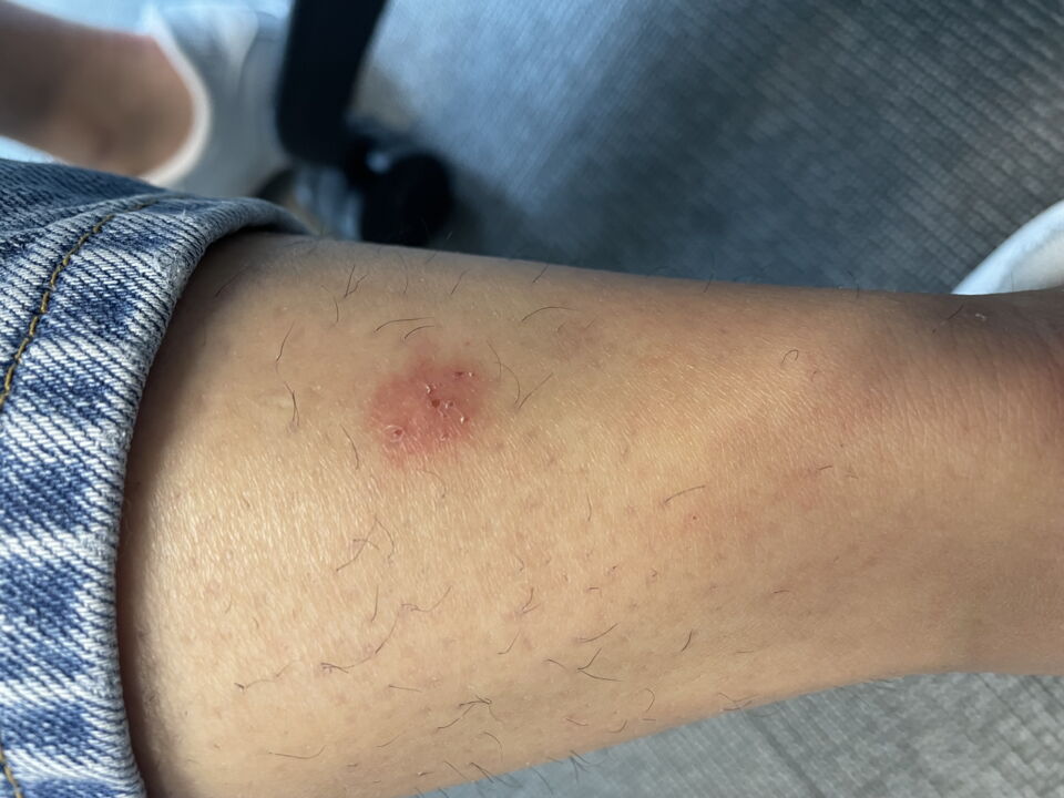 Paris Bed Bug infestation: How to tell the difference between theirs ...