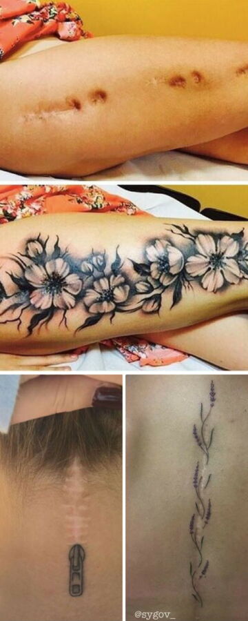Photos : 10 Brilliant Ways To Incorporate Scars With A Tattoo Design
