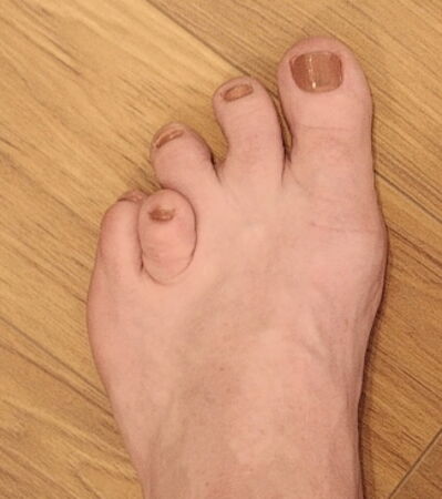 The worlds ugliest feet ranked